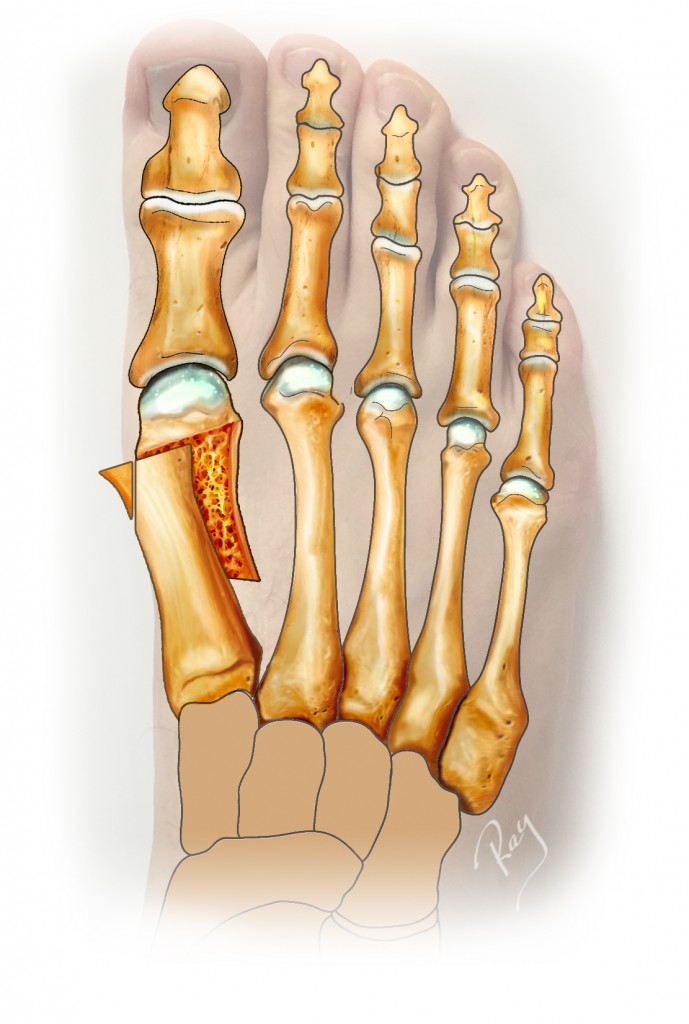 Hallux valgus : opération, traitement et origine | Centre du Pied